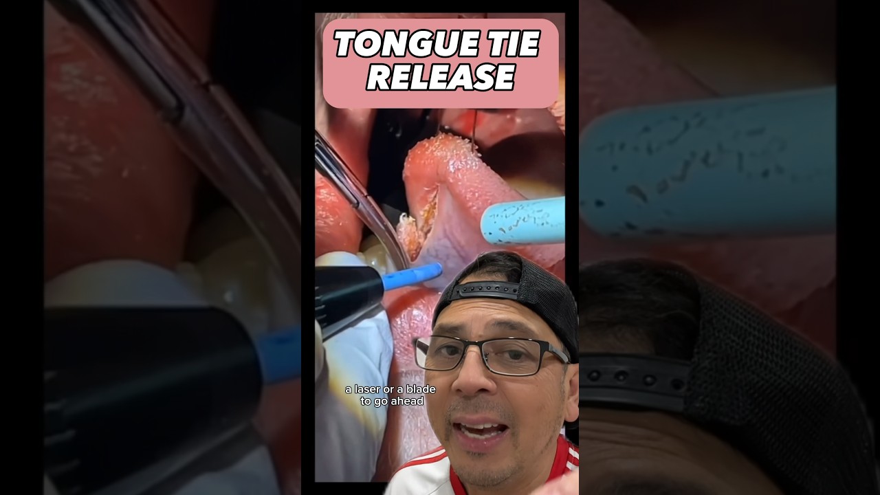 Adult Frenectomy Benefits Recovery Finding A Specialist Wiki
