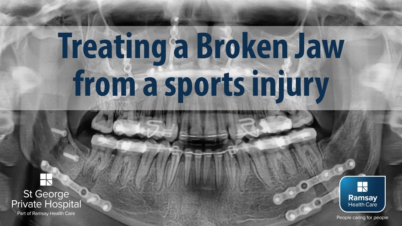 How Are Jaw Fractures From Sporting Injuries Treated Youtube