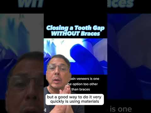 How To Reduce Tooth Gap Without Braces