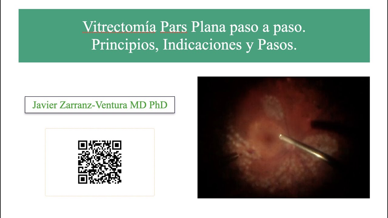 Vitrectomía Pars Plana Principios Indicaciones Y Pasos Youtube