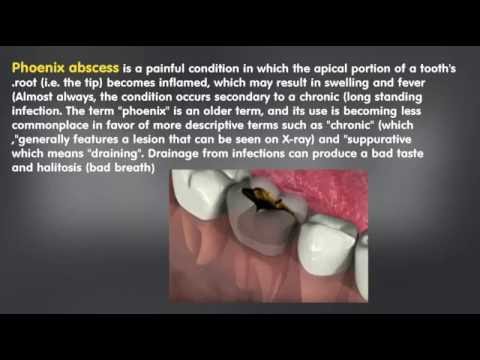 Phoenix Abscess Treatment Youtube