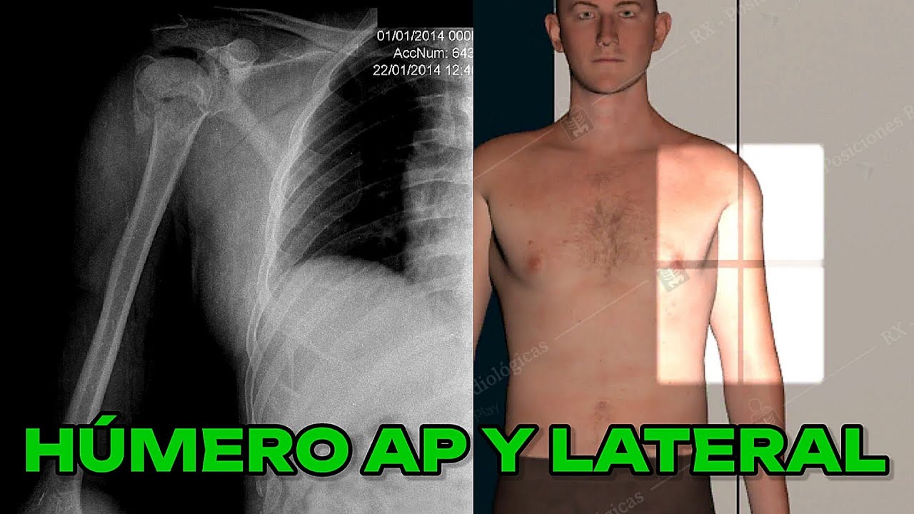Radiografía De Húmero Ap Y Lateral Manual De Bolsillo 13 Youtube