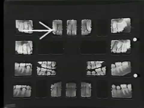 Pedodontic Radiographic Surveys Youtube