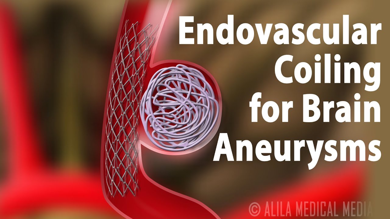 Endovascular Coiling For Brain Aneurysm Animation Youtube
