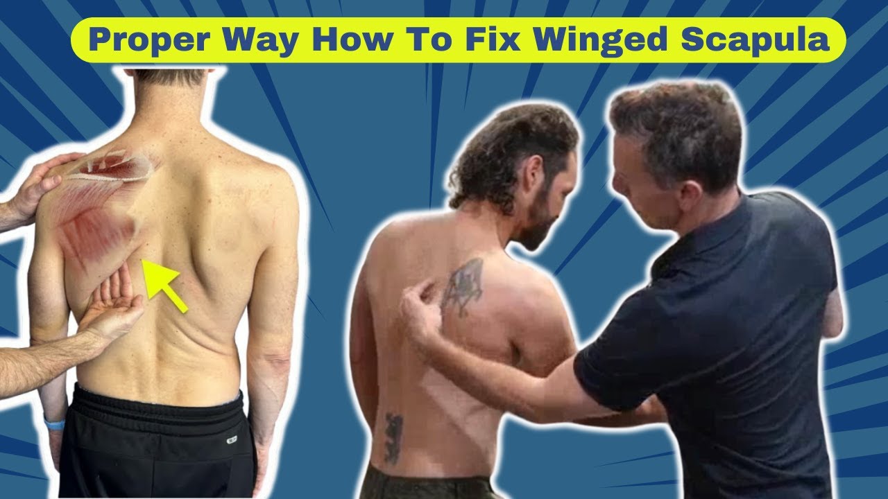 What Is Winged Scapula And How To Fix It Aeavu
