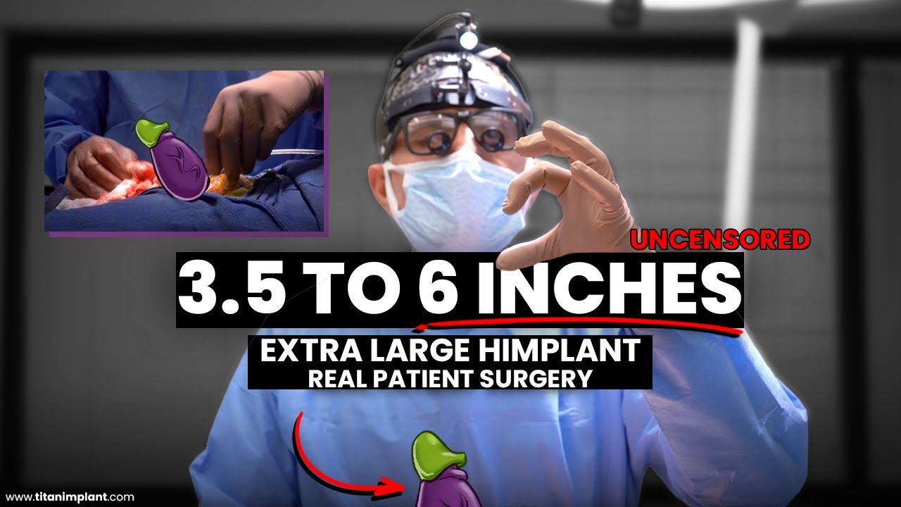 Uncensored 3 5 To 6 Inches Full Length Xl Himplant By Penuma