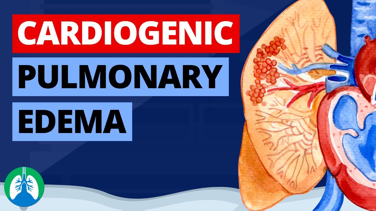 Cardiogenic Pulmonary Edema