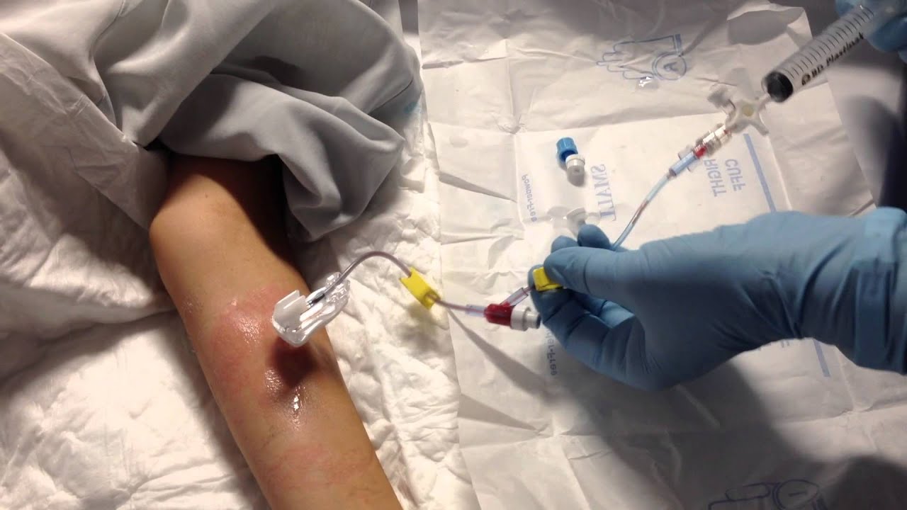 Canalizar Un Port A Cath En El Brazo Youtube