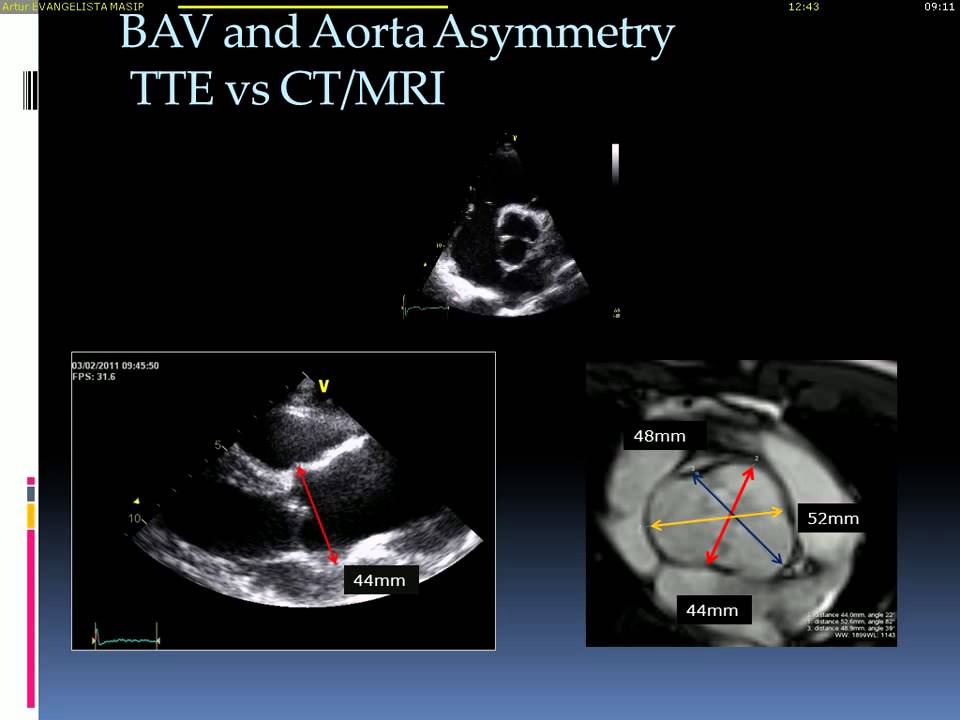 Echocardiographic Assessment Of Bicuspid Aortic Valve Youtube