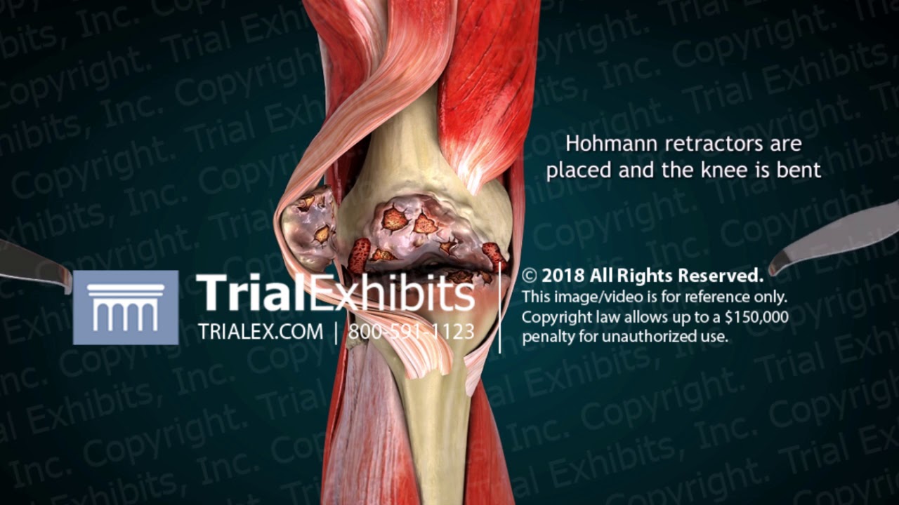 Total Knee Replacement Surgery Animation At Gene Courtney Blog