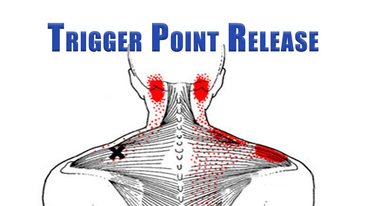 Trapezius Trigger Points