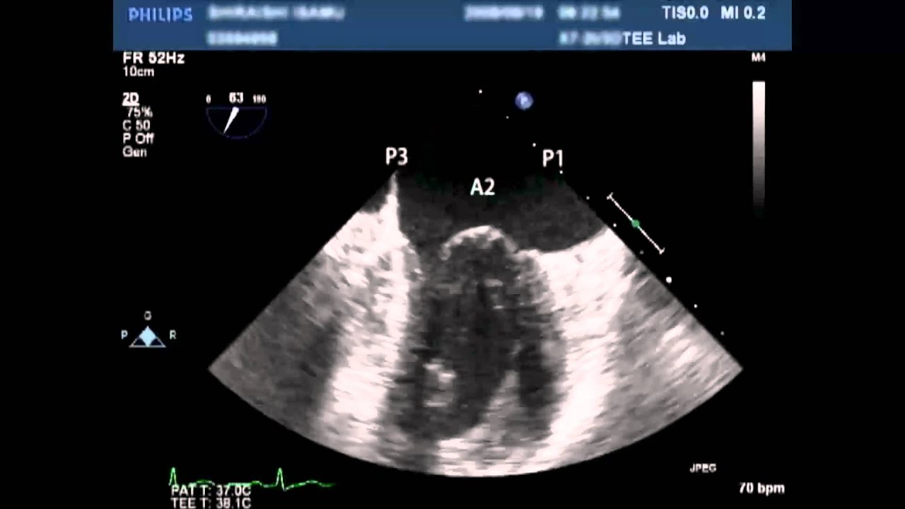 A2 Me Mitral Commissural Youtube