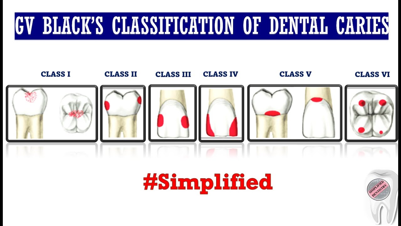 Gv Black S Classification Of Dental Caries Youtube
