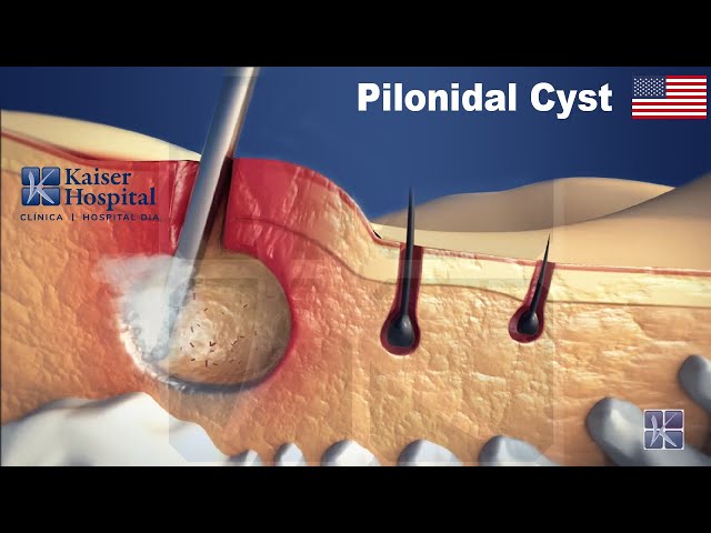 Pilonidal Cyst Different Types