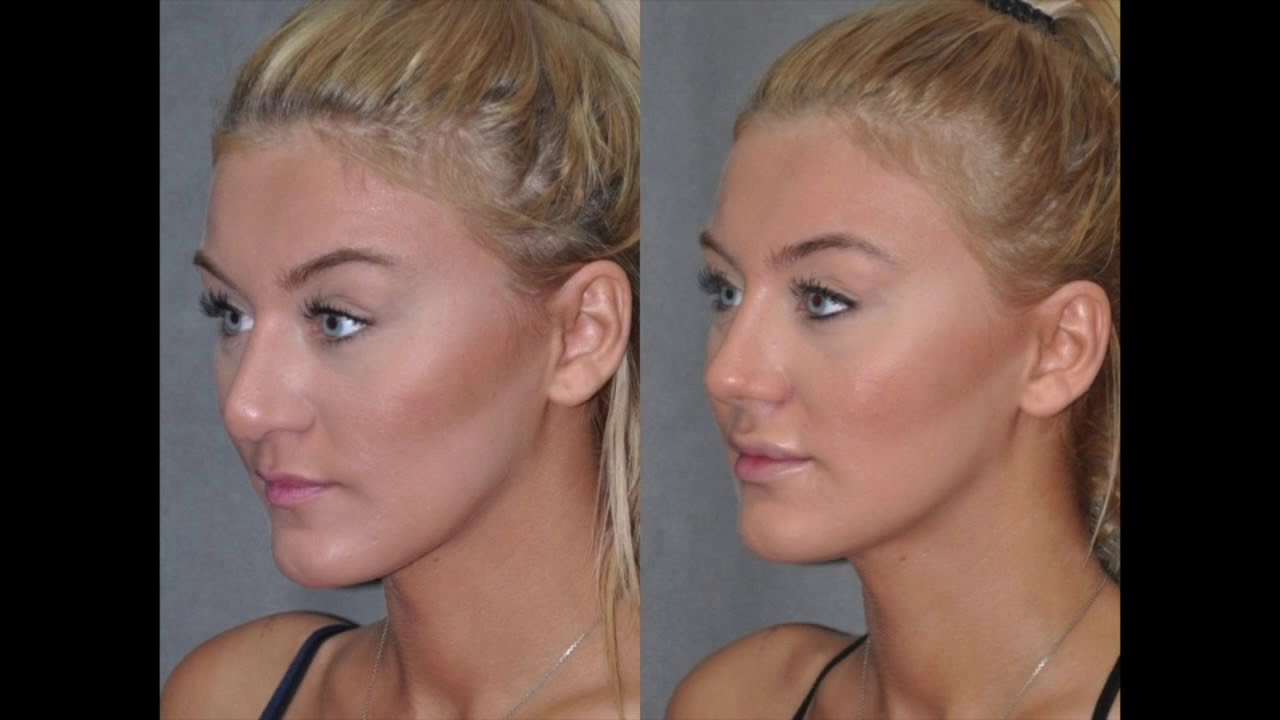 Incredible Best Nose Jobs Los Angeles Ideas My Reff