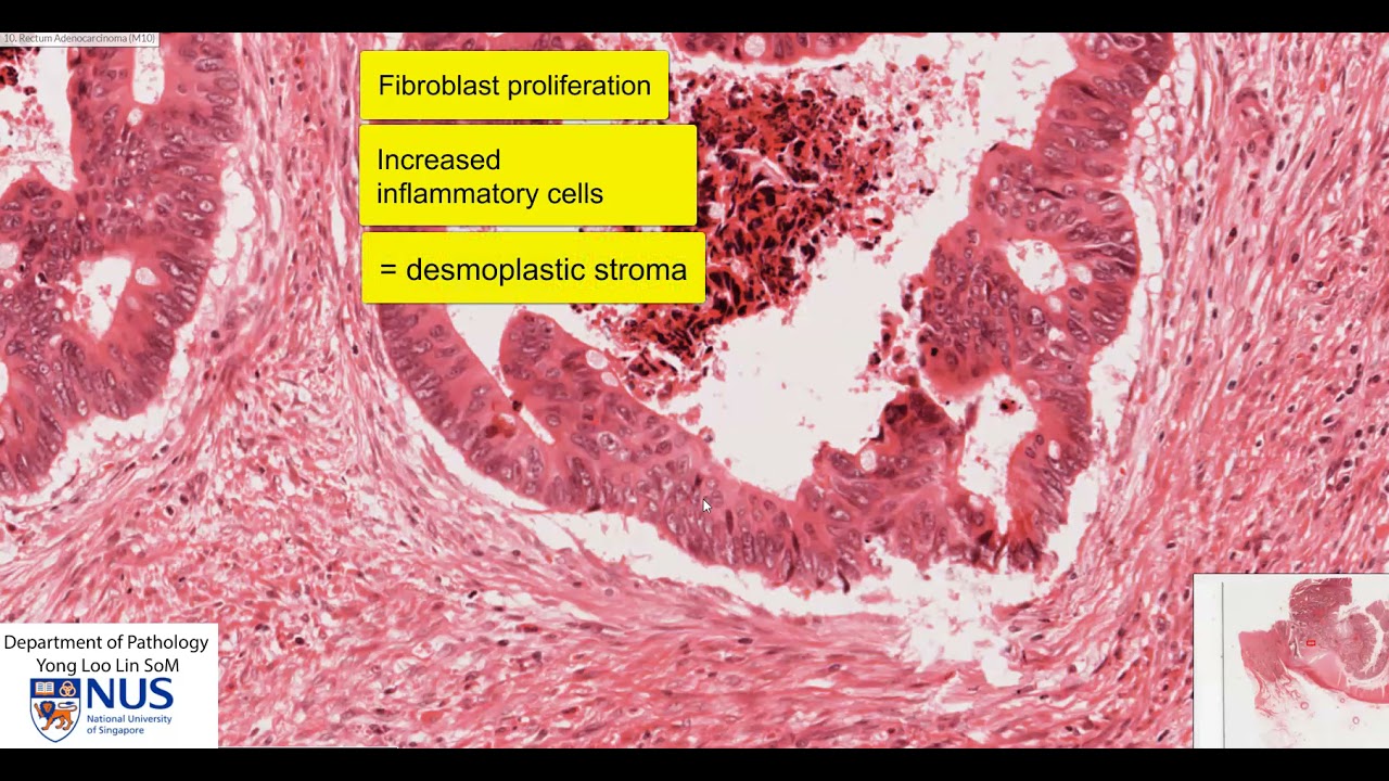 Colon Carcinoma Microscopy Talking Slide Youtube