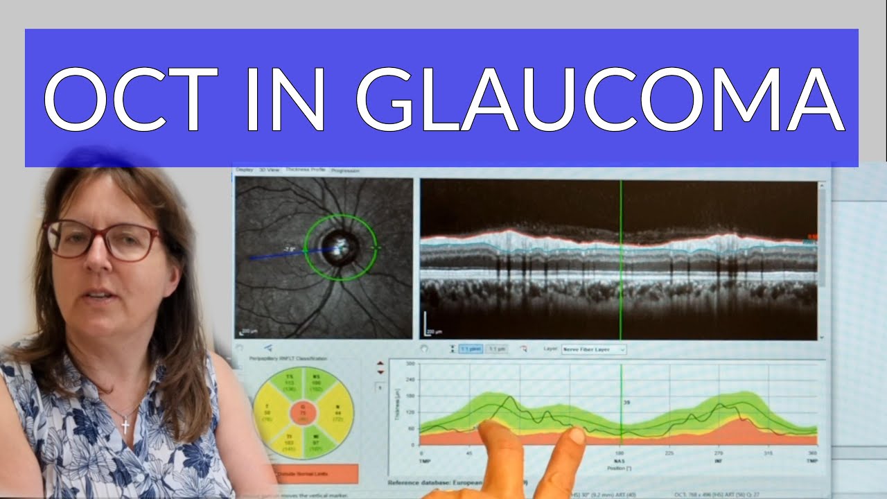 Using Oct In Glaucoma Tutorial For Beginners Youtube