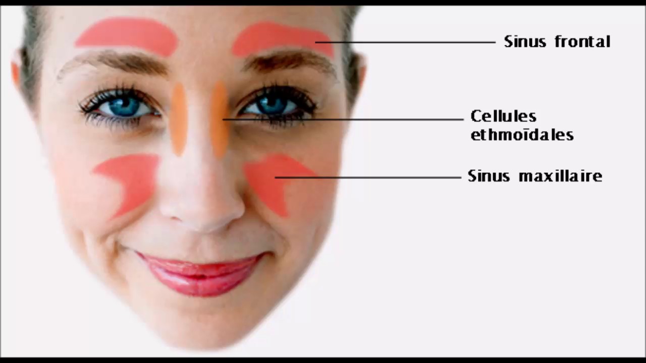 Inflammation Des Sinus Nasaux Sinusite Youtube