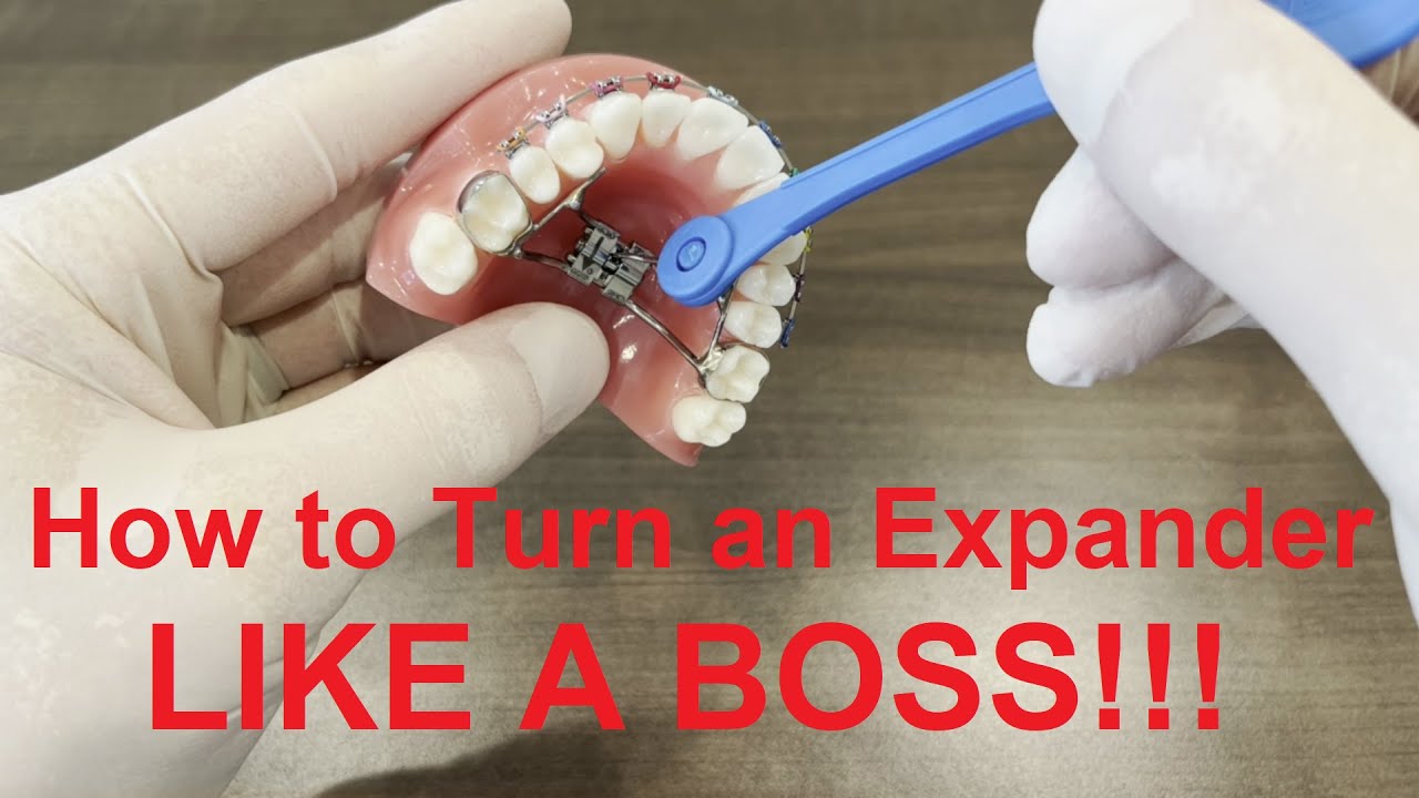 Turn Expander At Margaret Valez Blog