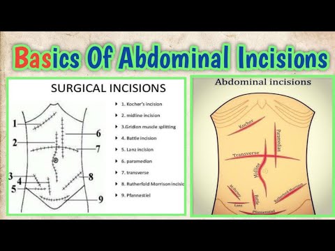 Abdominal Surgical Incisions