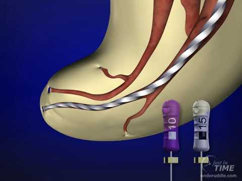Shape Clean Pack Glide Path Management Irregular Glidepath Dr