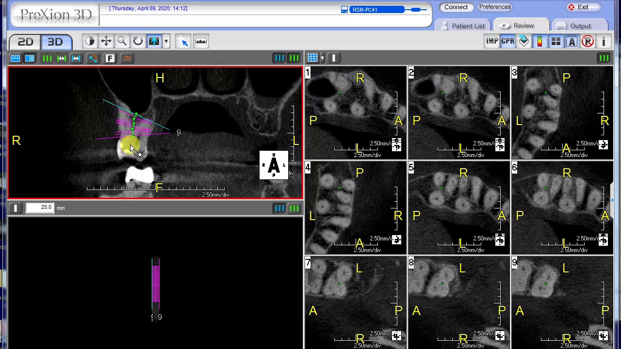 Prexion Training Tips Curved Planar Reconstruction Cpr Axial For