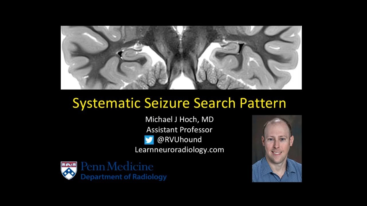 Brain Mri Seizure Search Pattern Youtube