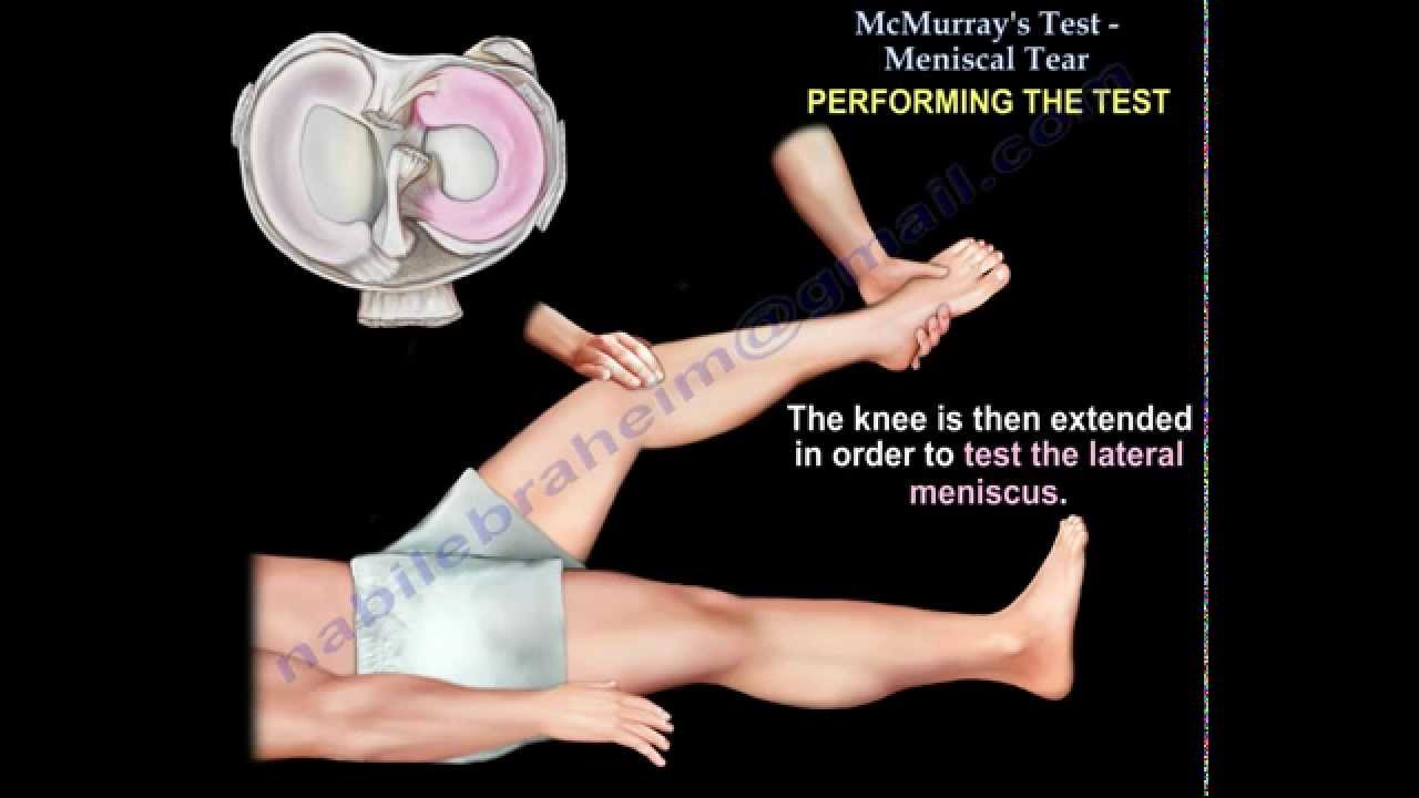 Mcmurray S Test Everything You Need To Know Dr Nabil Ebraheim