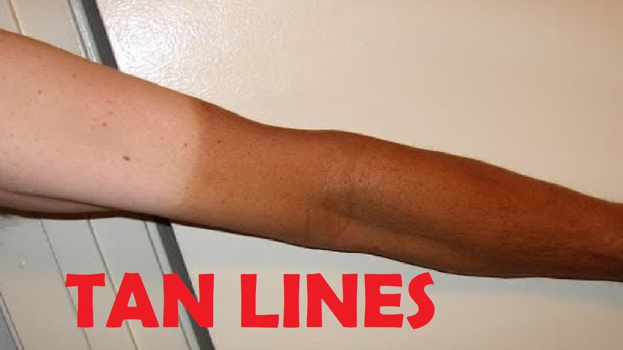How To Get Rid Of Tan Lines On Arms Detroit Chinatown