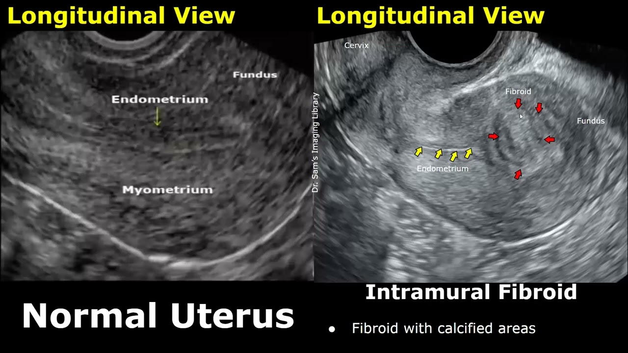 Uterine Fibroids Ultrasound