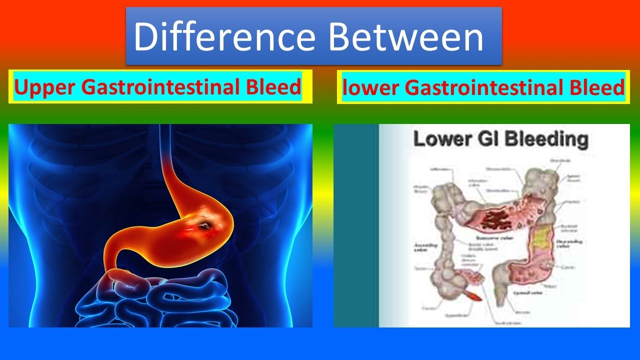 Gastrointestinal Bleeding Massive Gi Bleed Management First10em
