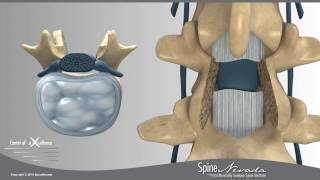 Lumbar Fusion Surgery Explained Spinal Stability Pain Relief 3d ...