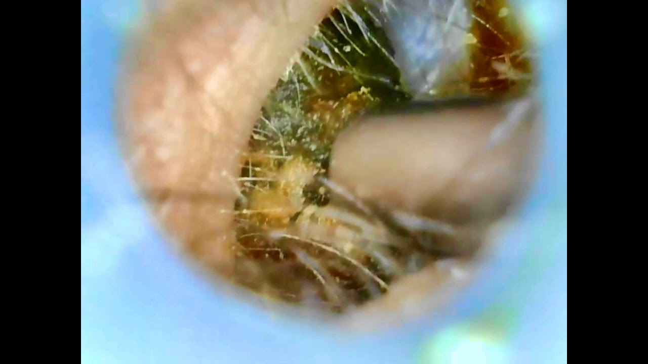 Satisfying Ear Wax Removal Compilation 1 Youtube