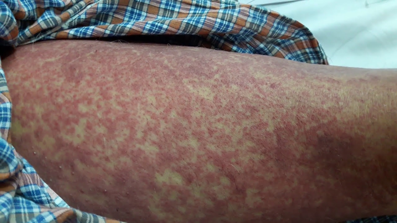 Medication Rashes Pictures At Christopher Hannan Blog