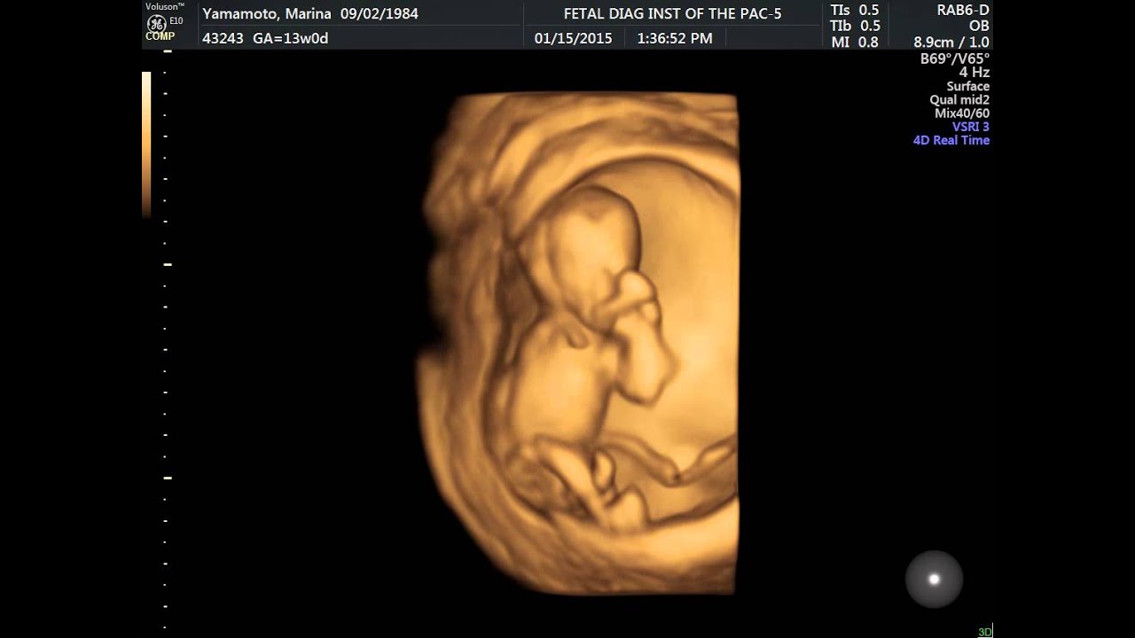 Baby Boy Ultrasound 13 Weeks At Aurora Mcdonald Blog