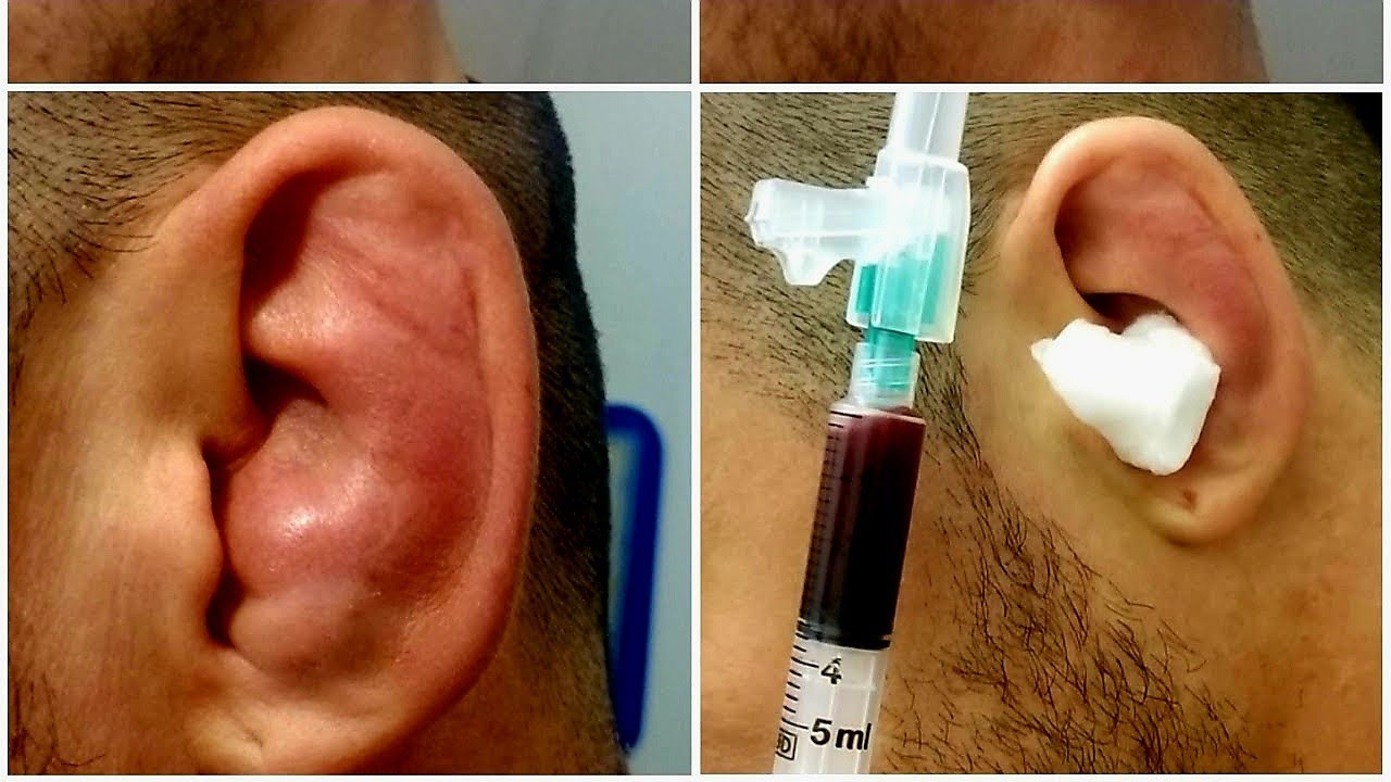 Cauliflower Ear When To Drain At Shelia Blake Blog