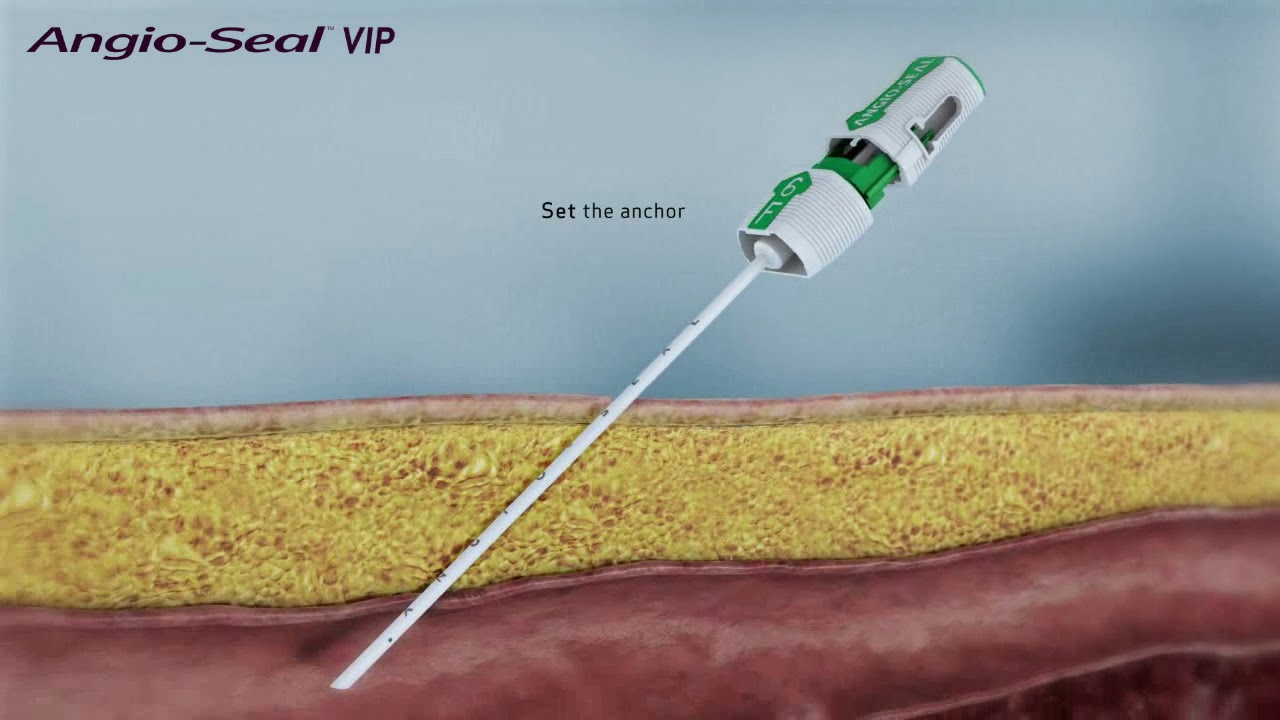 Angioseal Video Youtube