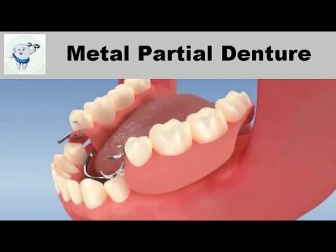Metal Partial Denture Animation Youtube