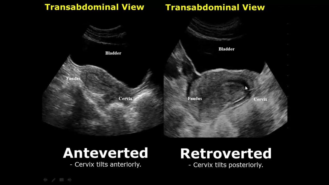 Retroverted Uterus Transabdominal Ultrasound Retroverted Retroflexed