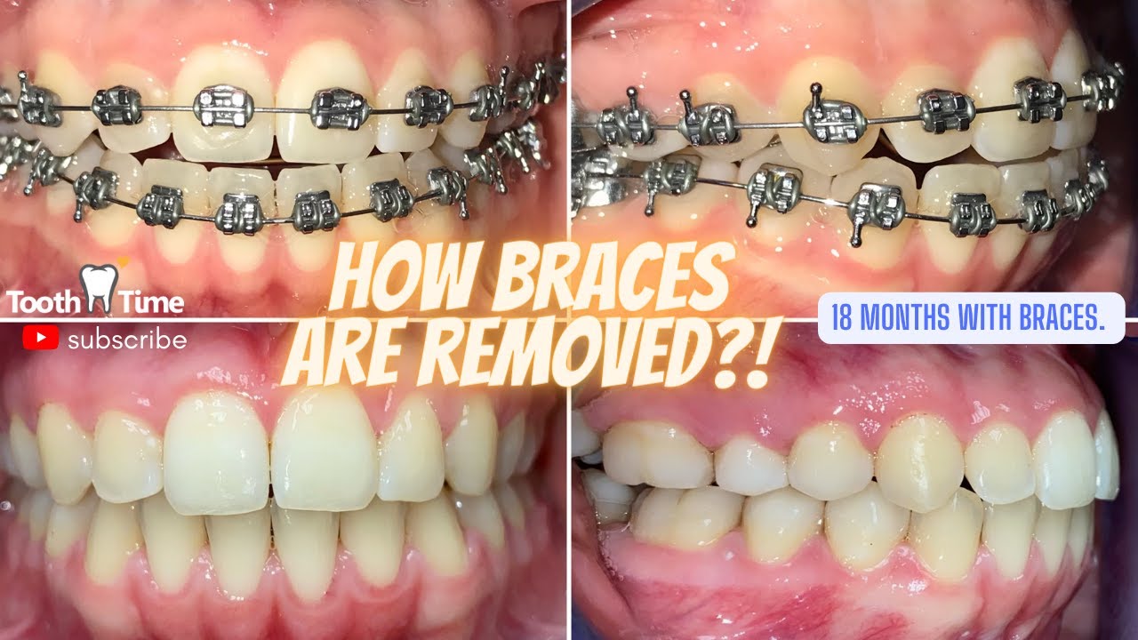 Take Out Braces Online