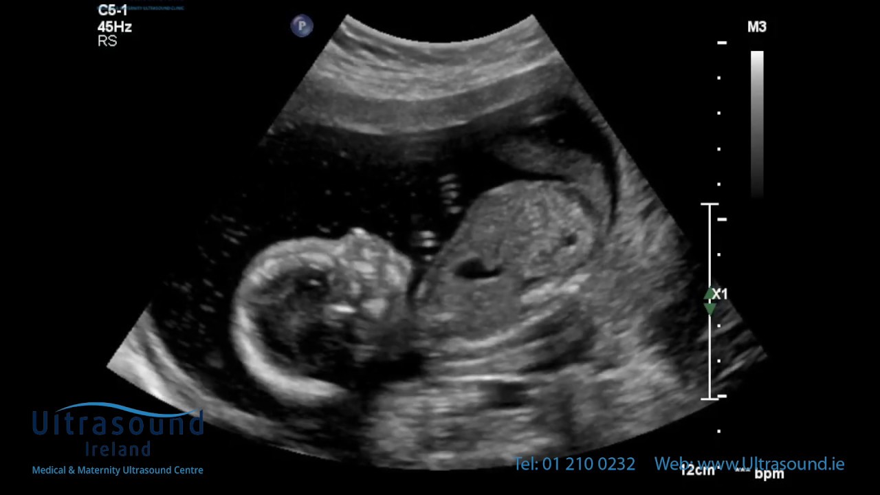 Normal Female Anatomy And How It Is Seen On An Ultrasound