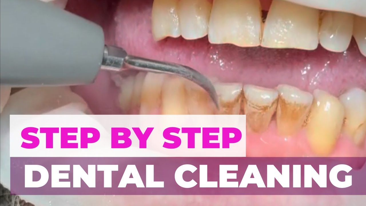 Step By Step How Dental Cleaning And Polishing Is Done Youtube
