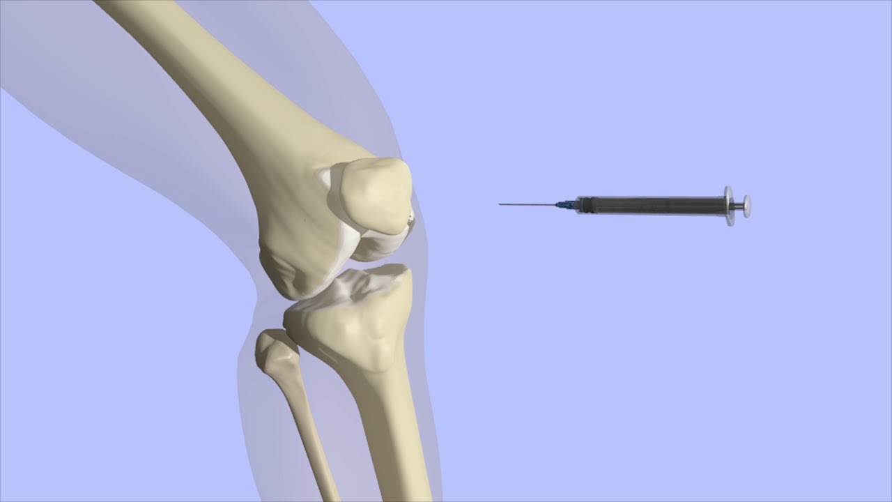 Knee Joint Injection Youtube