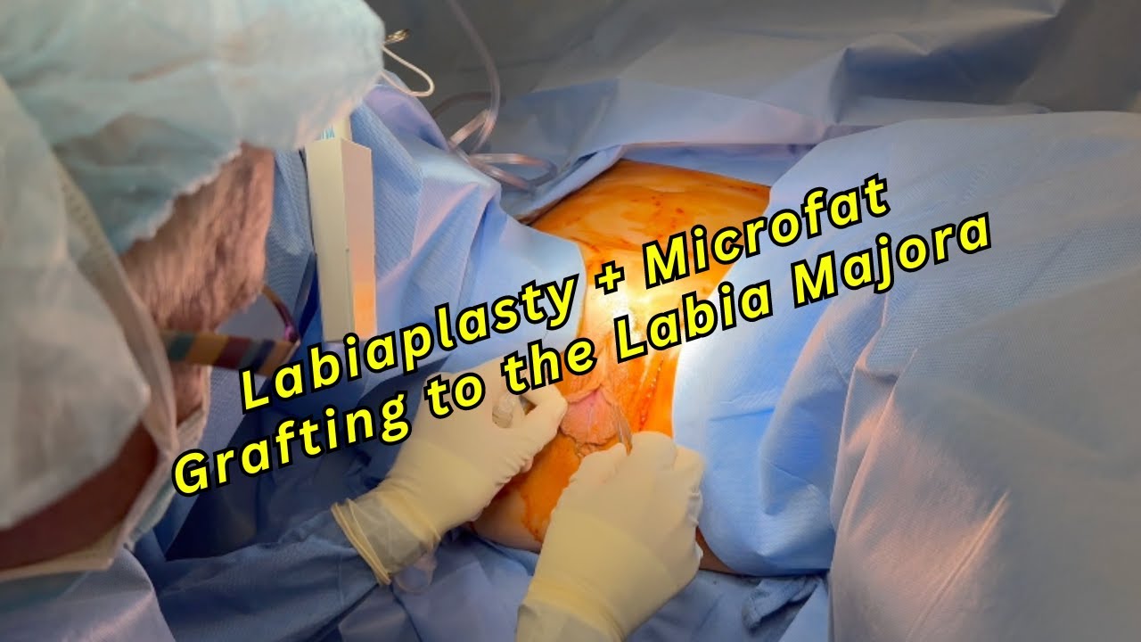 Labiaplasty Fat Grafting To The Labia Majora Youtube