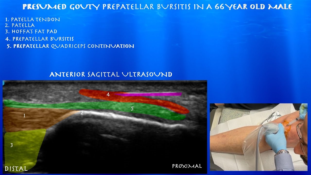 Cortisone Injection For Prepatellar Bursitis At Alejandro Harden Blog
