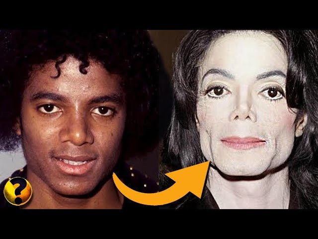 Vitiligo Michael Jackson Antes E Depois