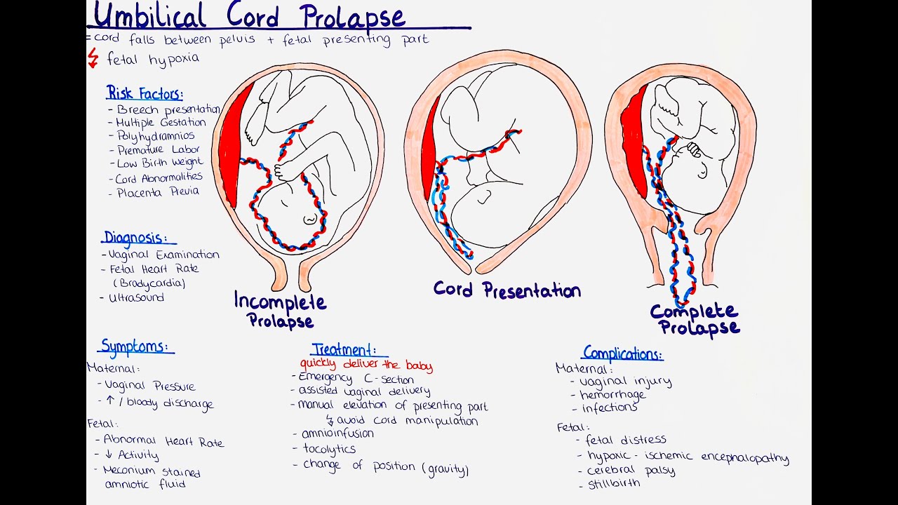 Nuchal Cord Treatment Umbilical Cord Prolapse Definition Causes
