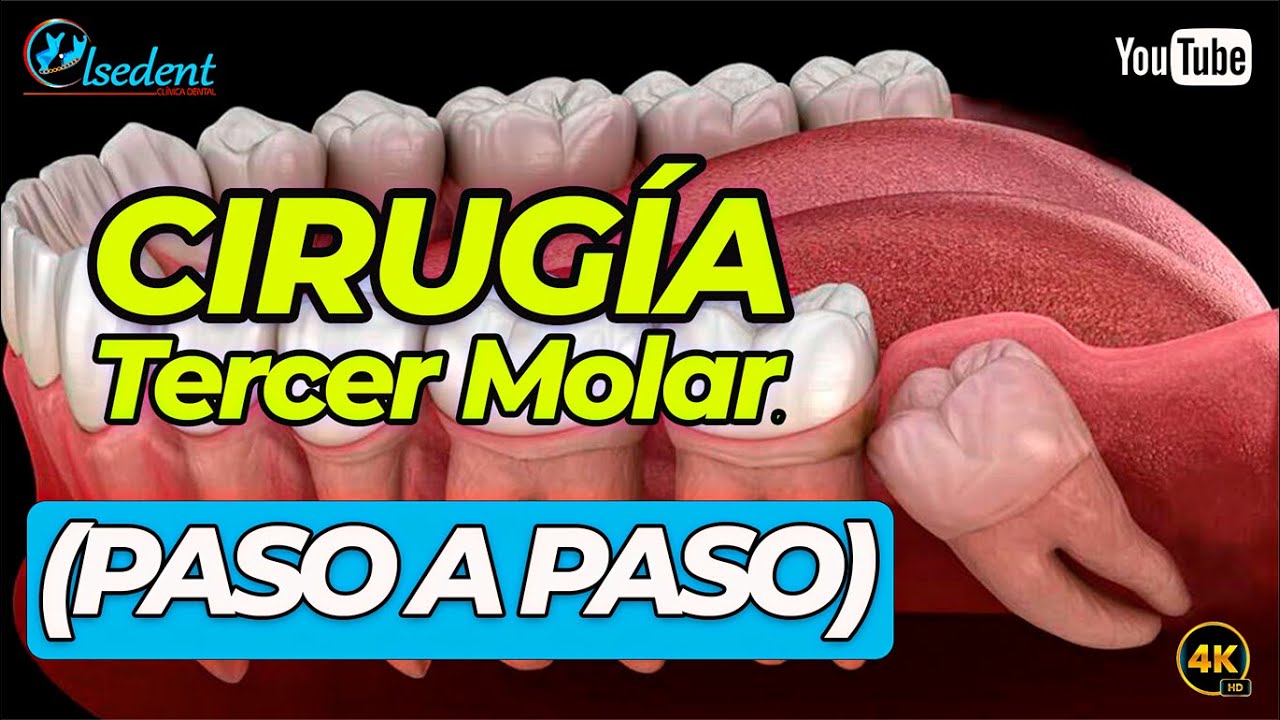Cirugía De Tercer Molar Paso A Paso Youtube