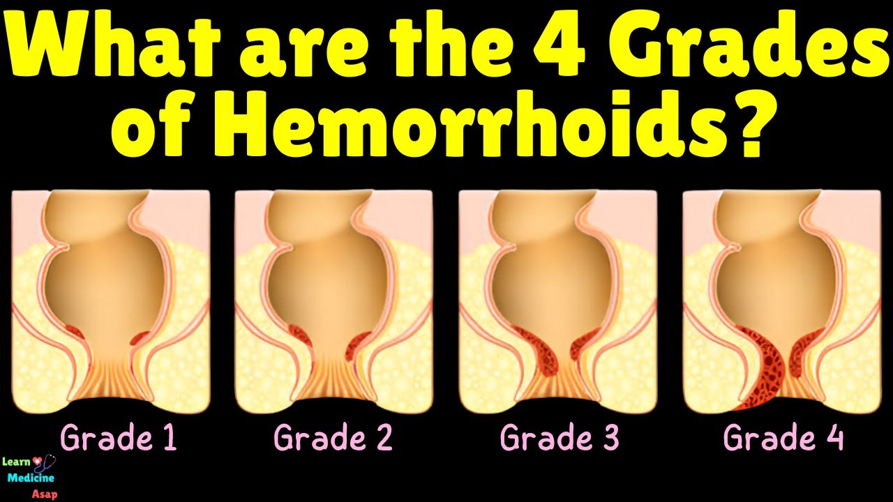 Hemorrhoids Grading What Are The 4 Grades Of Hemorrhoids Youtube