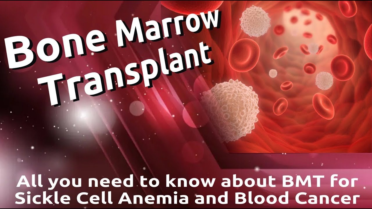 Sickle Cell Anemia Bone Marrow Transplant